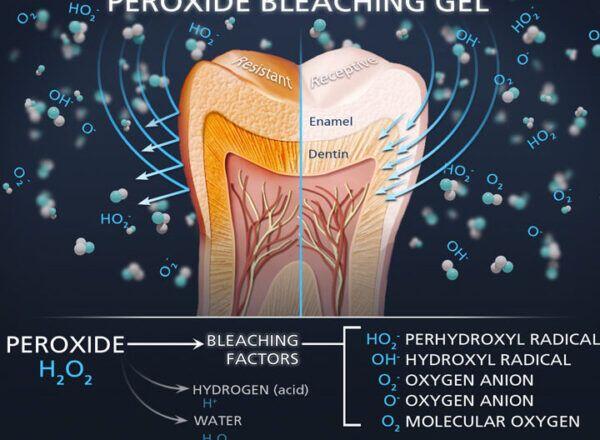 WHITENING GELS bij BLEKEN: EFFECTIVITEIT ONTHULD!