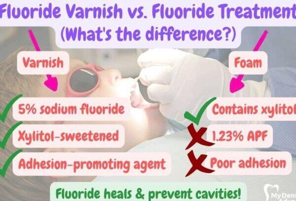 FLUORIDE GEL of MONDSPOELING? Ontdek de BESTE KEUZE!