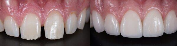 Natuurlijke LOOK: Esthetische RESTAURATIES voor Glimlach!
