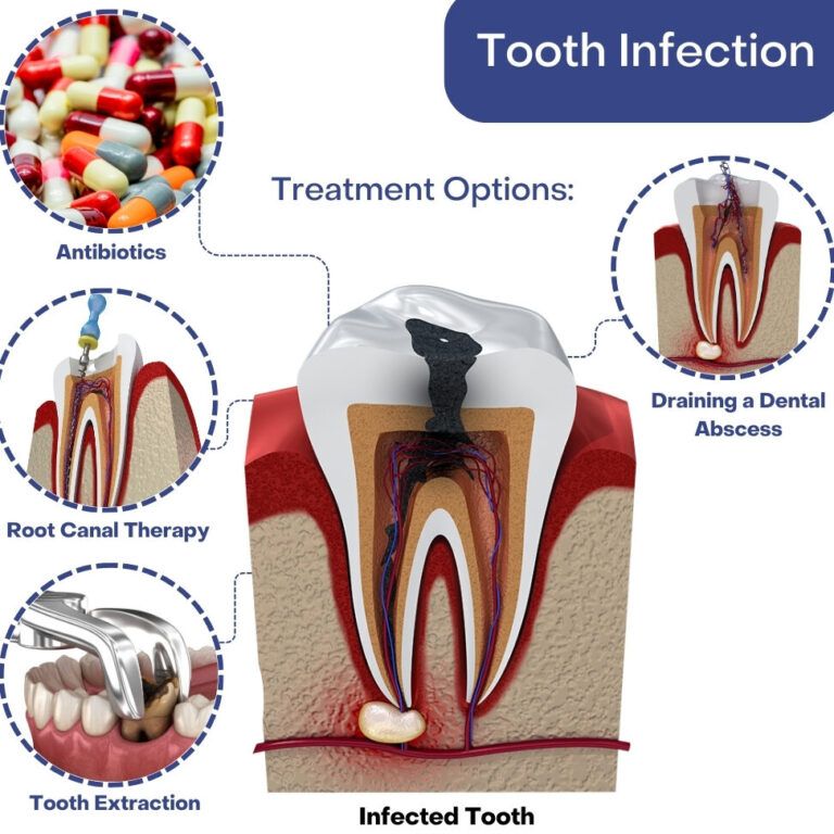 Ontstoken Kies: BELANGRIJKE Symptomen en BEHANDELINGEN!