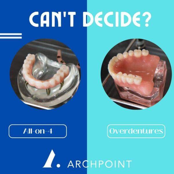 Ontdek de VOORDELEN van All-on-4 vs TRADITIONELE protheses!