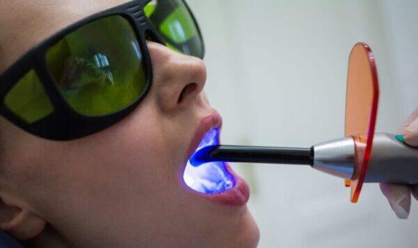 Innovaties in LASER BLEKEN - Toekomst van TANDVERLICHTING!