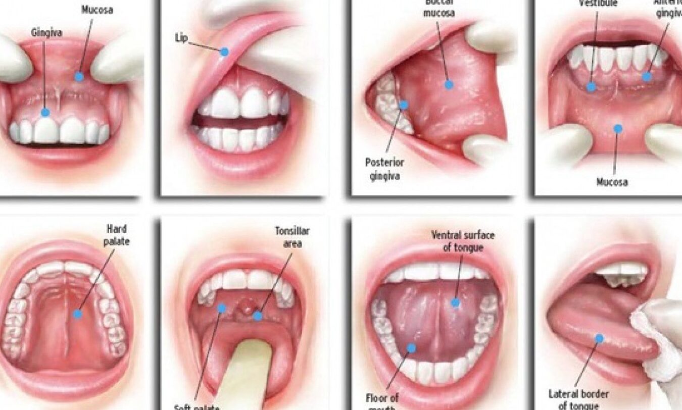 KIESPIJN & MONDKANKER: VROEGE SYMPTOMEN HERKENNEN