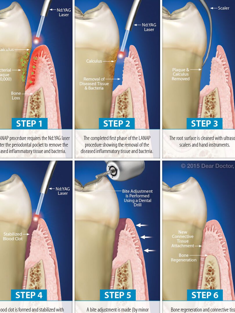 Laserbehandeling voor PARODONTITIS: STAPPEN & PROCEDURE!