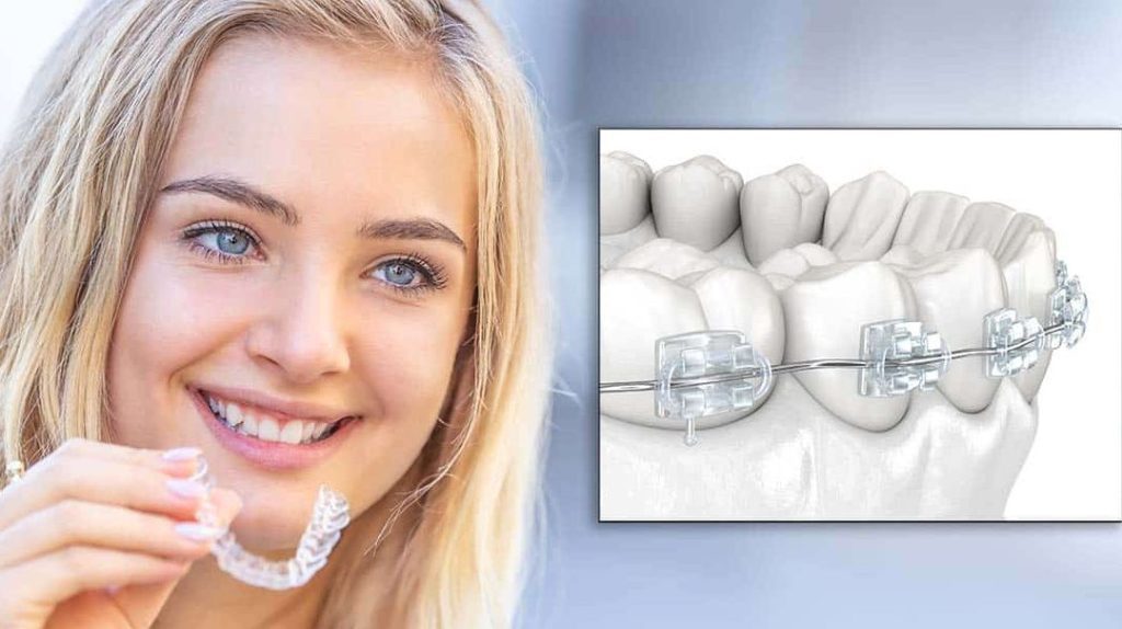 Invisalign & TRANSPARANTE BEUGELS: Vergelijk Jouw OPTIES!