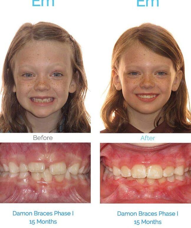 RESULTATEN van Beugels bij Kinderen: Voor & Na FOTOS!