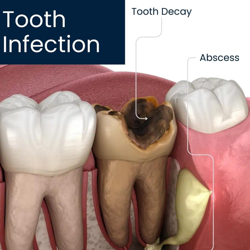 ONTSTOKEN KIES en HOOFDPIJN: Ontdek het Verband!
