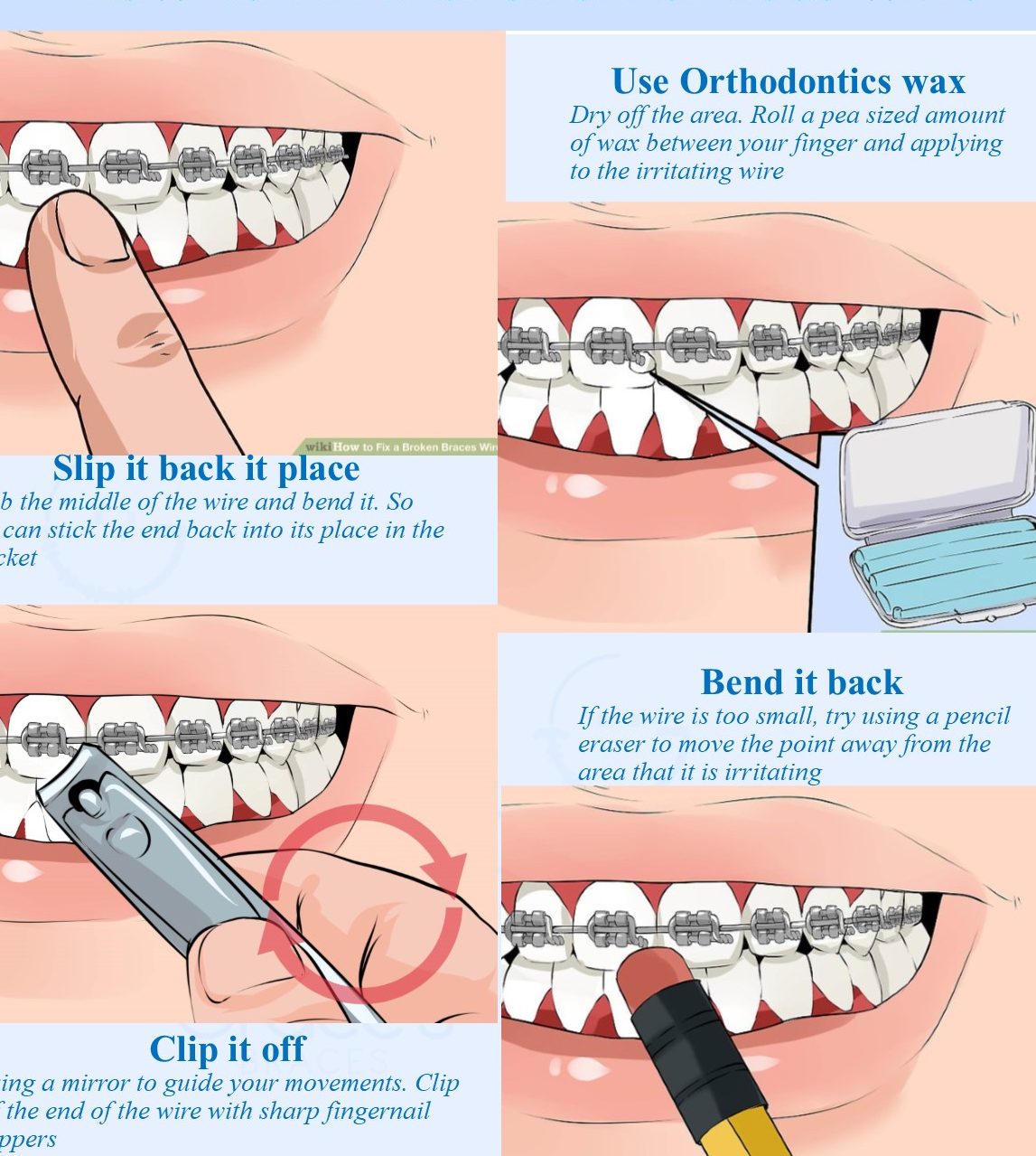 Beugel en Orthodontische Wax: JUISTE TIPS voor Gebruik!