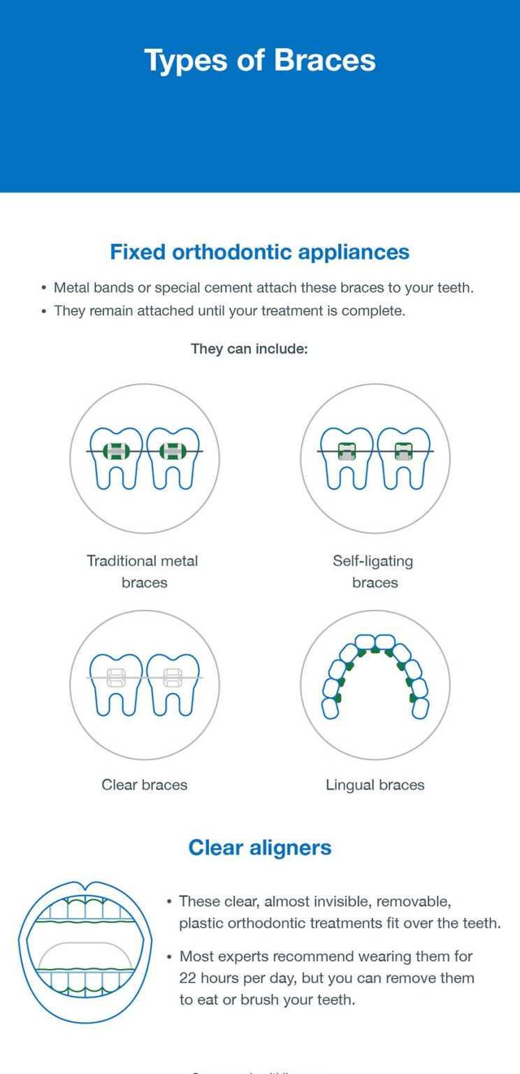 Retainer in MONDGEUR: TOP TIPS om Slechte Geur te Voorkomen