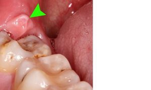 ONTSTOKEN KIES & LYMFKLIEREN: OORZAKEN, SYMPTOMEN!