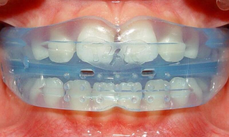 Permanente Beugel en Digitale Orthodontie: De Toekomst van Mondzorg en ...
